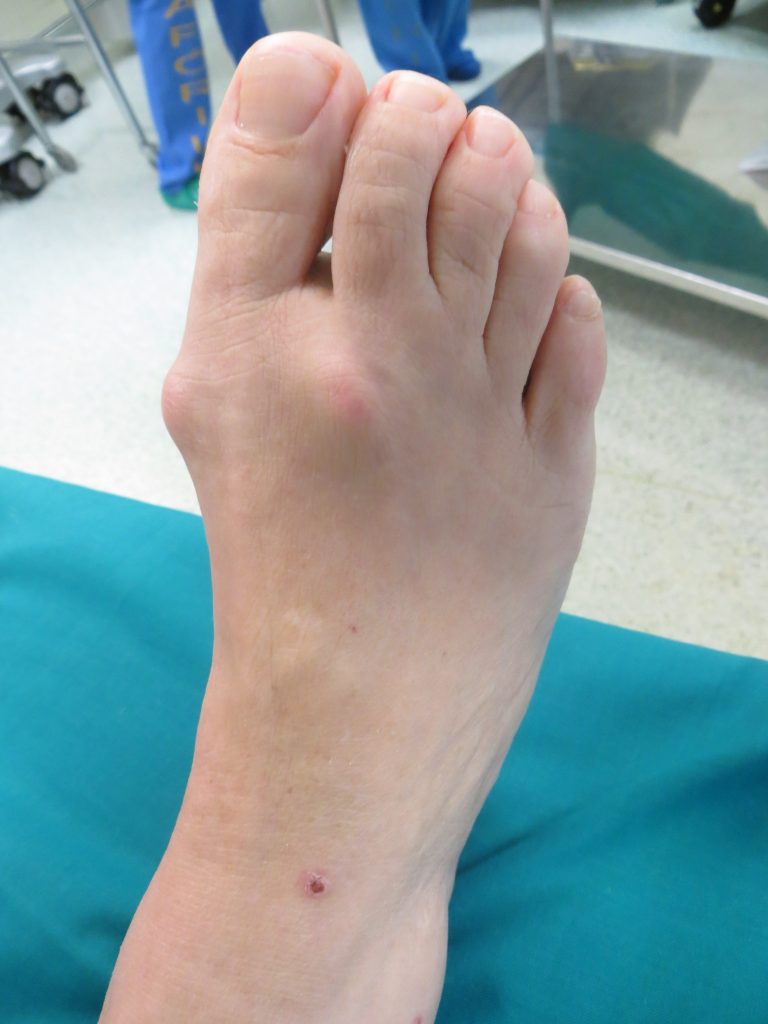 Enfermedad de Freiberg: Información importante – Podovita - Cliníca del ...