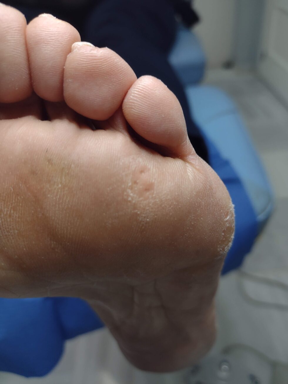 ¿Sabes lo que son los Helomas? ¡Te lo contamos! – Podovita - Cliníca ...